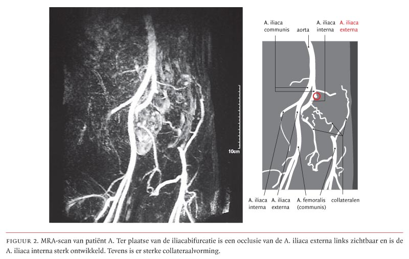 Claudicatio intermittens bij een 26-jarige wielrenner | Nederlands ...