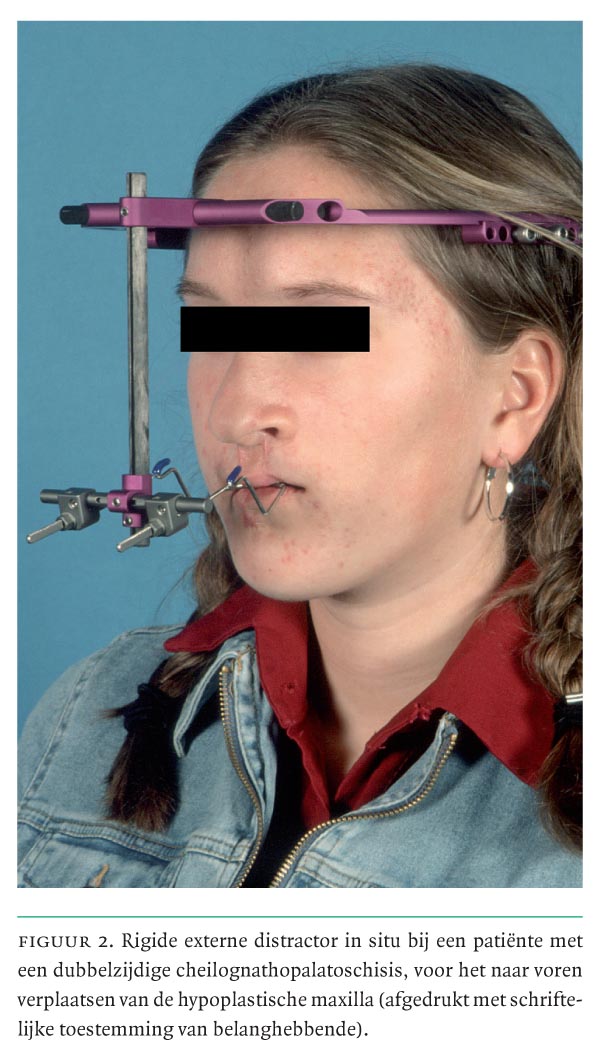 Distractieosteogenese in het hoofd-halsgebied | Nederlands Tijdschrift ...