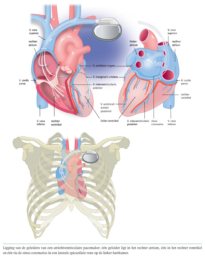 Niet-farmacologische behandeling van hartfalen: implanteerbare ...