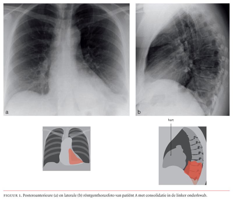 Geen pulmonaal infiltraat, maar een longsekwester bij een 45-jarige ...
