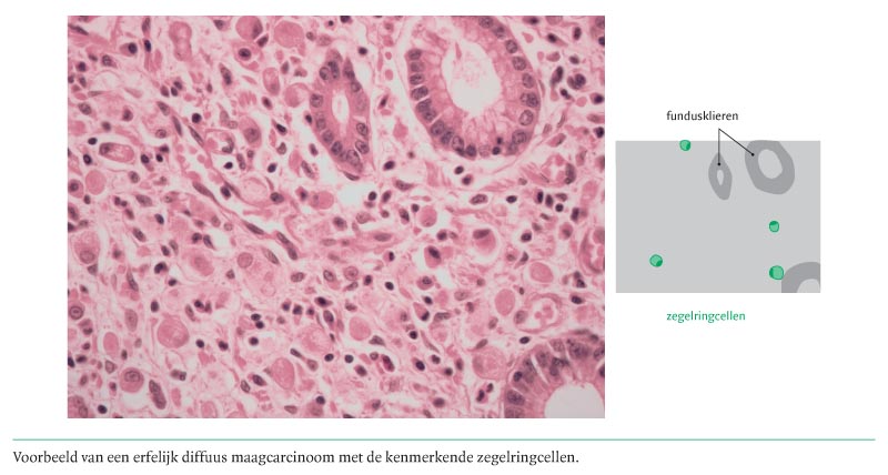 Preventieve resectie van erfelijk, diffuus maagcarcinoom | NTVG