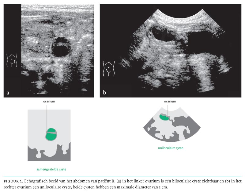 Foetale en neonatale ovariumcysten als toevalsbevinding bij echografie ...