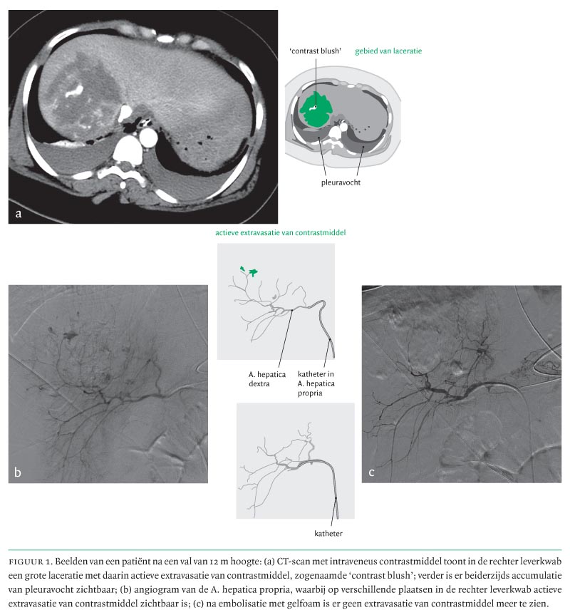 Angiografie en embolisatie van bloedingen na stomp buik- of ...