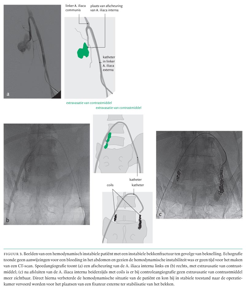 Angiografie en embolisatie van bloedingen na stomp buik- of ...