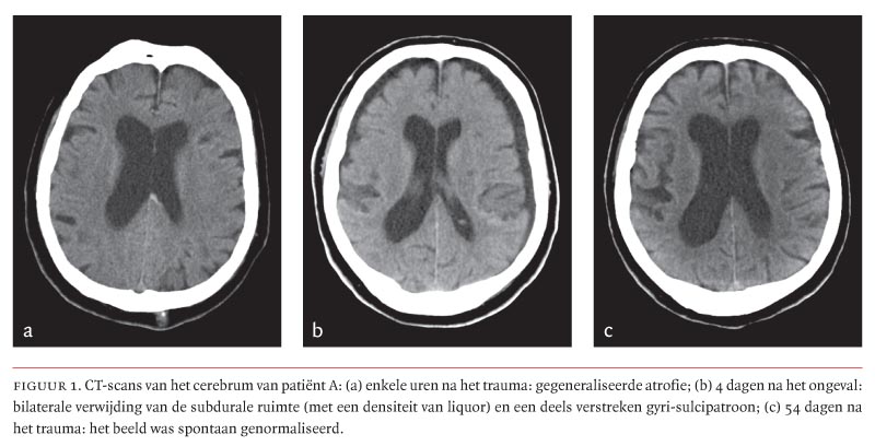 Een subduraal hygroom na een val van de trap | Nederlands Tijdschrift ...