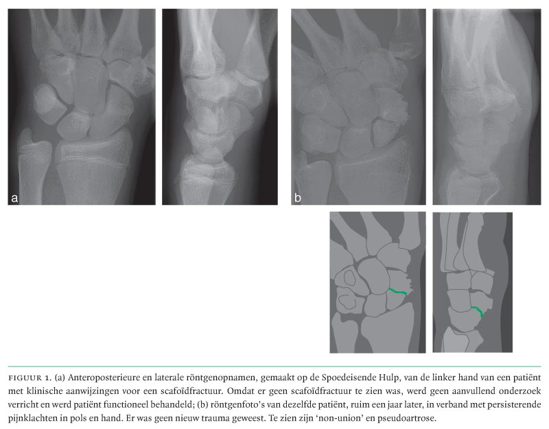 Scafoïdfracturen: diagnostiek en therapie | NTVG