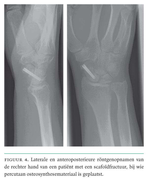 Scafoïdfracturen: diagnostiek en therapie | NTVG
