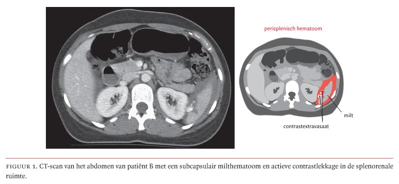 Succesvolle behandeling van miltbloedingen met behoud van de milt door ...