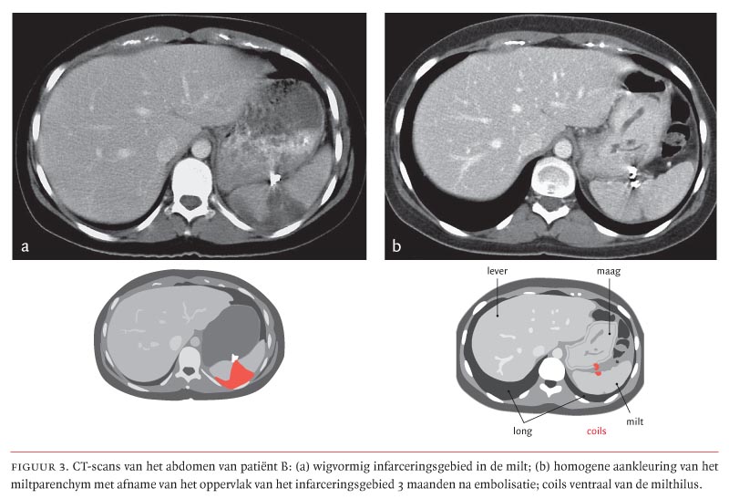 Succesvolle behandeling van miltbloedingen met behoud van de milt door ...