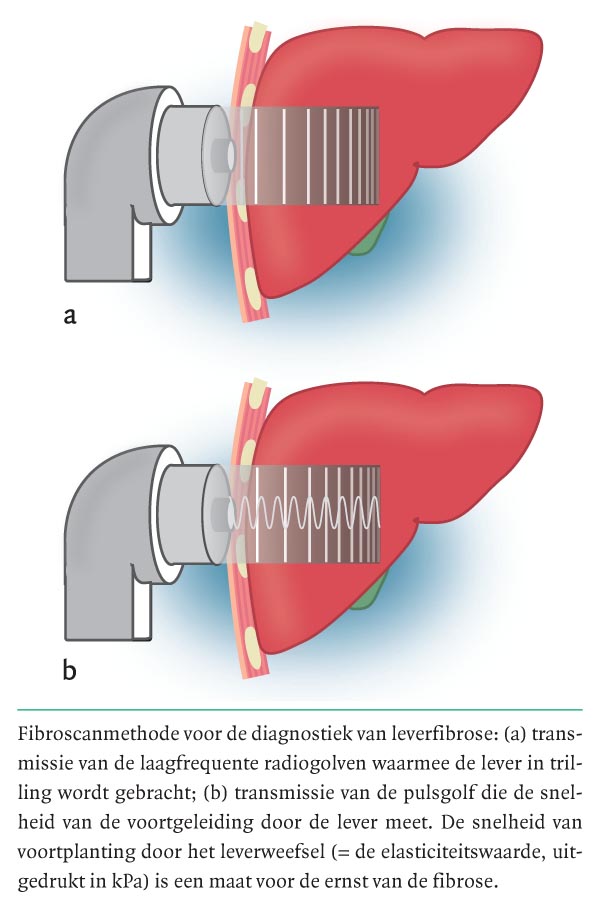 Diagnostiek van leverfibrose en -cirrose | NTVG