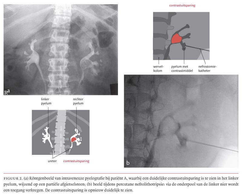 Drie patiënten met urolithiasis als bijwerking van behandeling met ...