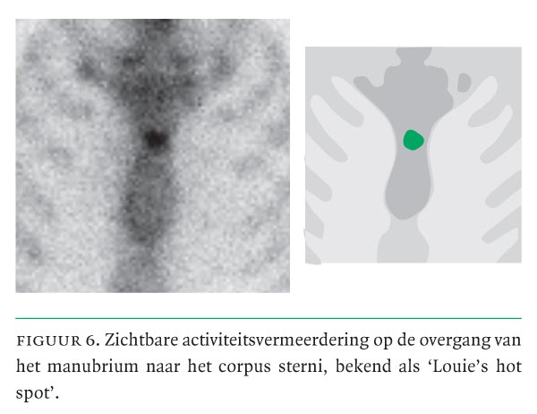 Een solitaire sternumhaard op het skeletscintigram na behandeling ...