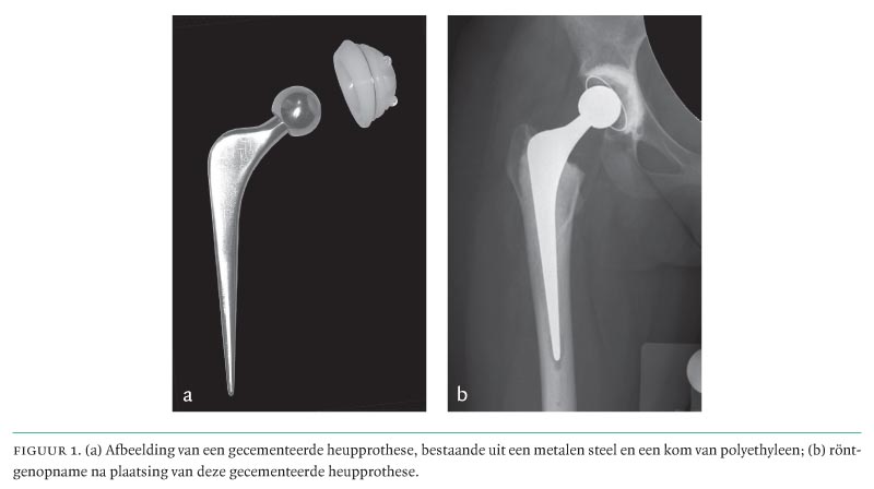 Keuze van heupprothese voor patiënten jonger dan 50 jaar | NTVG