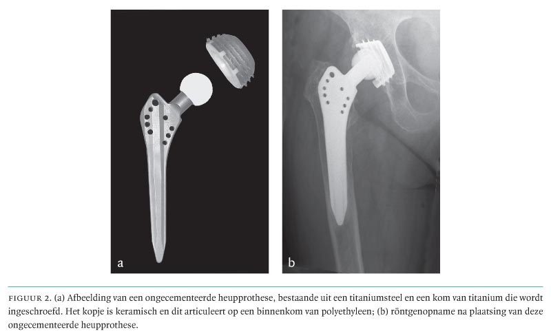 Keuze van heupprothese voor patiënten jonger dan 50 jaar | NTVG
