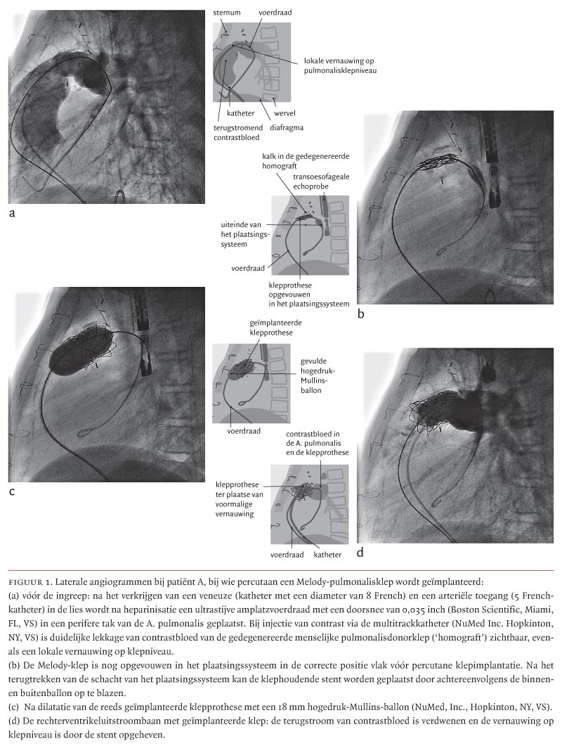 Percutane implantatie van een pulmonalisklep bij 3 kinderen met ...