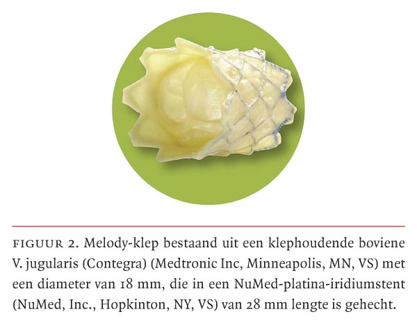 Percutane implantatie van een pulmonalisklep bij 3 kinderen met ...