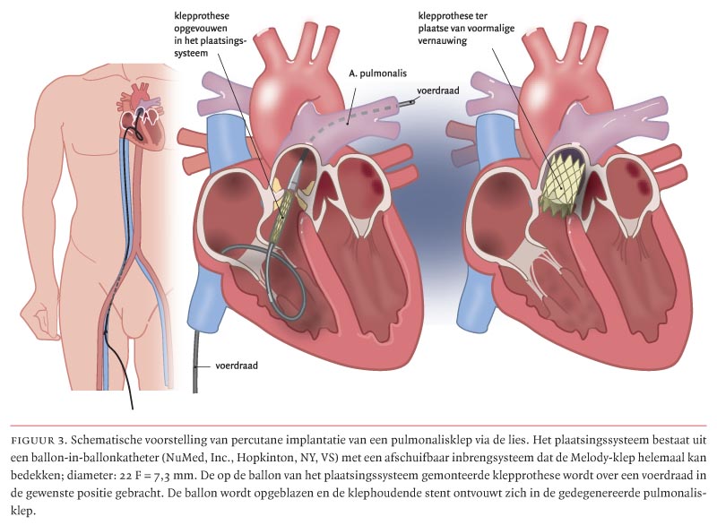 Percutane implantatie van een pulmonalisklep bij 3 kinderen met ...