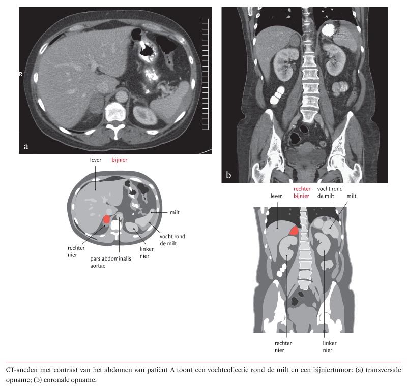 Een incidentaloom van de bijnier bij een traumapatiënt; pleidooi voor ...