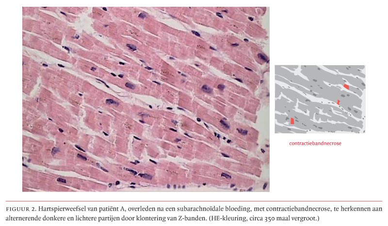 Subarachnoïdale bloeding met de klinische presentatie van een ...