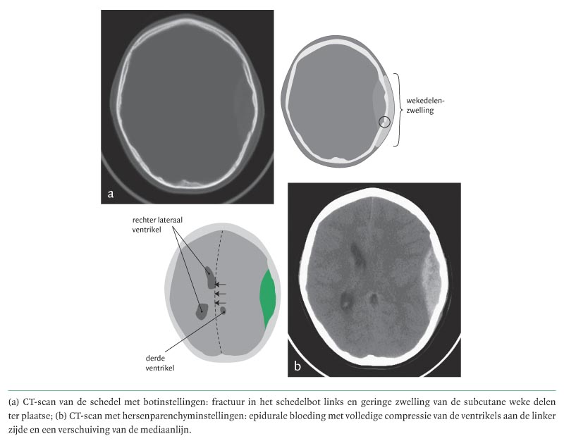 Diagnose in beeld (361). Een jongen met hoofdpijn en braken 2 dagen na ...