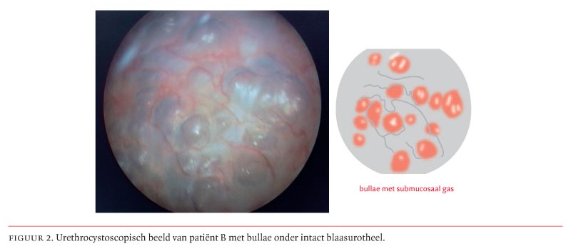 Emfysemateuze cystitis: van bullae tot pneumaturie | NTVG