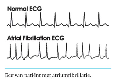 Plasminogeenactivatorremmer-1 voorspelt atriumfibrillatie na ...