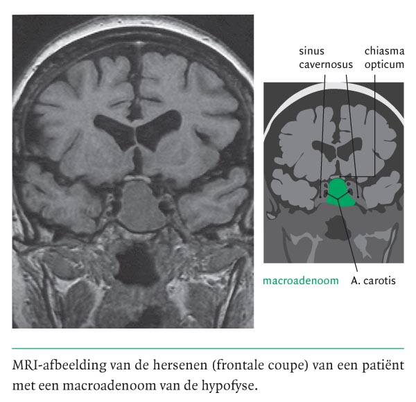 Niet-functionerende macroadenomen van de hypofyse: diagnostiek ...