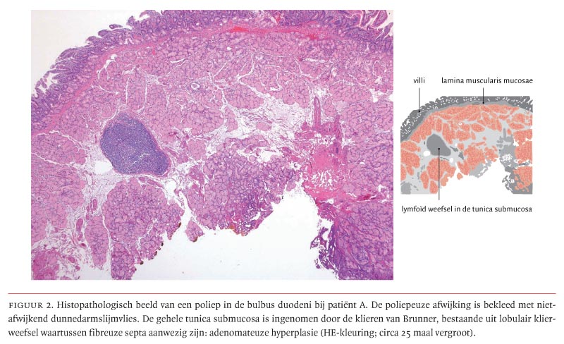 Melena op basis van een brunner-adenoom | NTVG