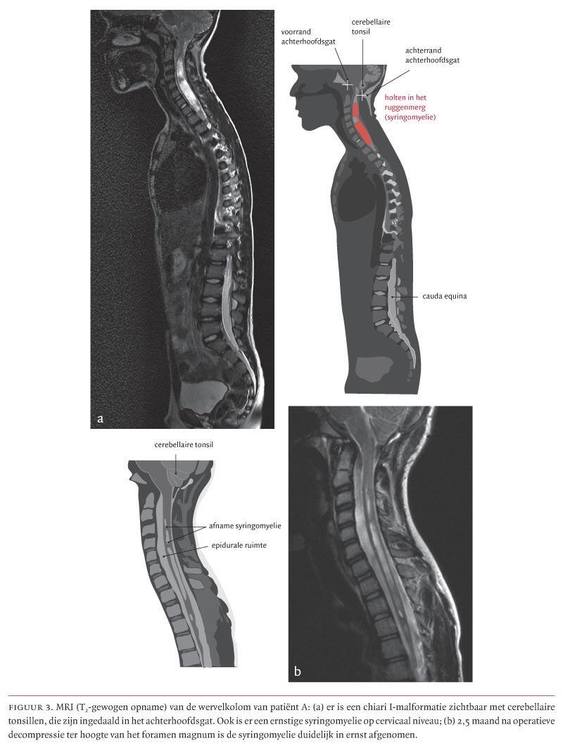 Syringomyelie en een chiari-malformatie bij een kind met scoliose ...