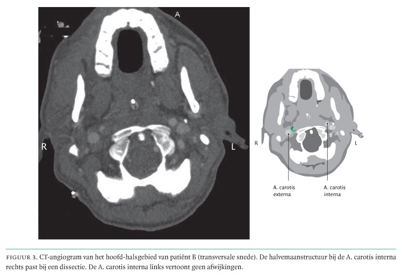 Dissectie van de A. carotis door een stomp trauma: nog altijd een ...