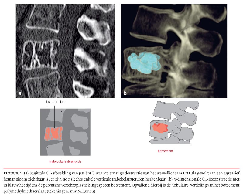 Percutane vertebroplastiek bij wervelfracturen door de ziekte van ...