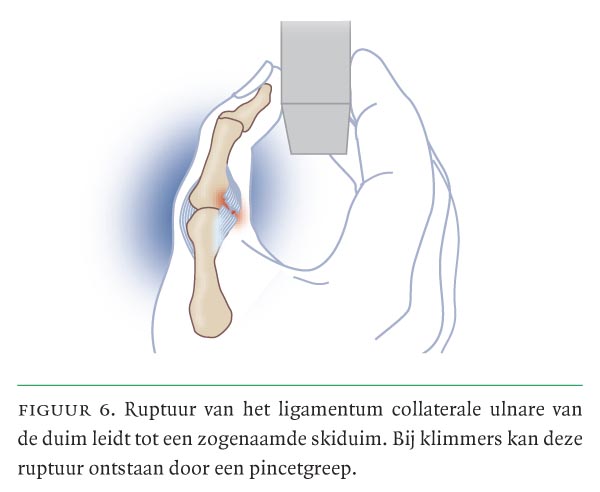 Blessures aan de arm bij sportklimmers | Nederlands Tijdschrift voor ...
