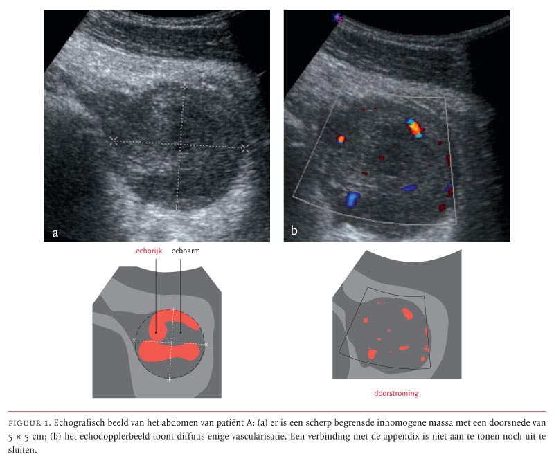 Een ongebruikelijke manifestatie van een periappendiculair infiltraat ...
