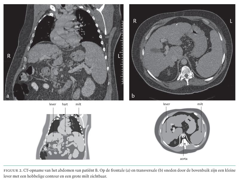 Levercirrose bij diabetes mellitus, een niet altijd onderkende ...