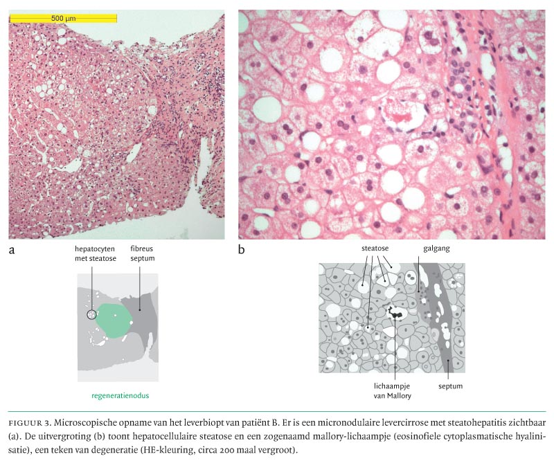 Levercirrose bij diabetes mellitus, een niet altijd onderkende ...