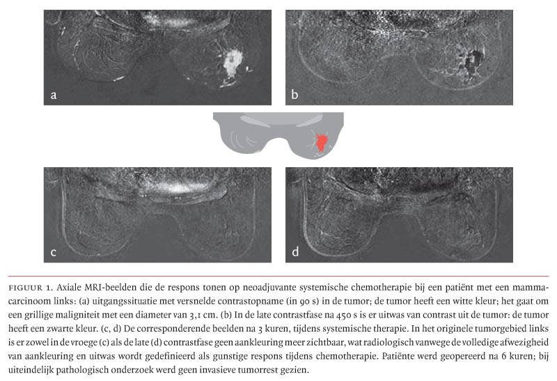 Neoadjuvante systemische therapie bij het primair operabel ...