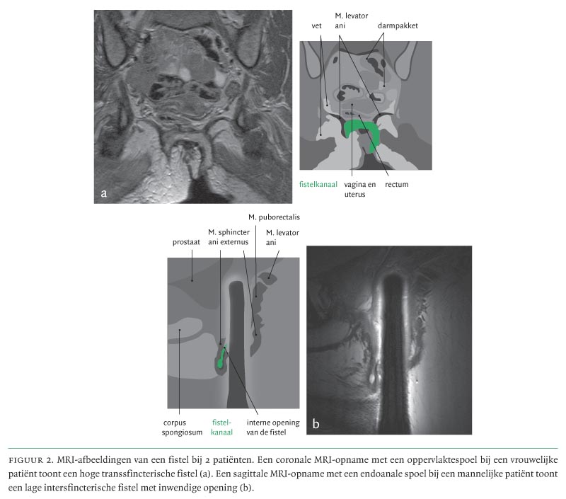 Perianale fistels: veranderde inzichten met betrekking tot ...
