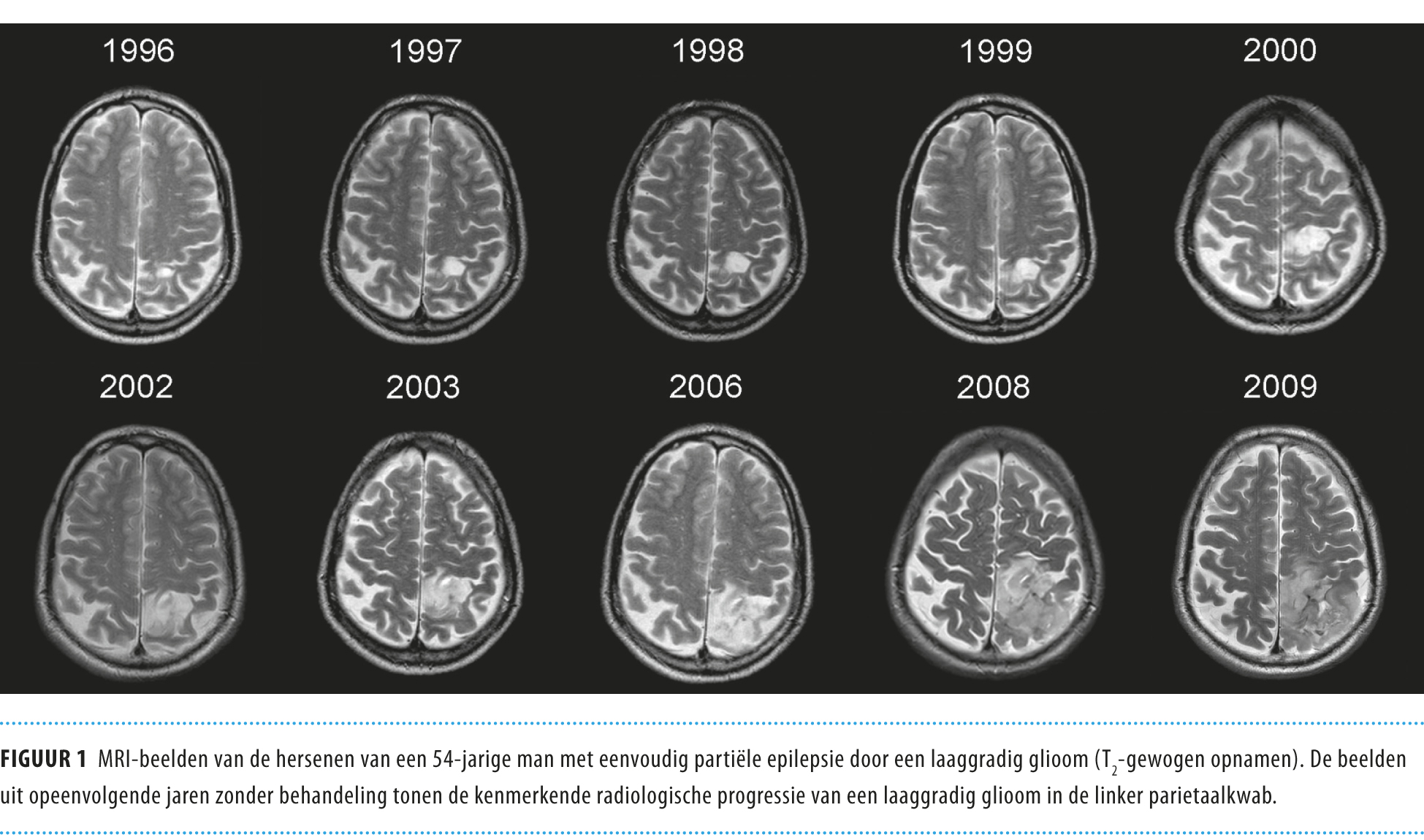 Beloop en beleid bij vermoeden van een laaggradig glioom | Nederlands ...