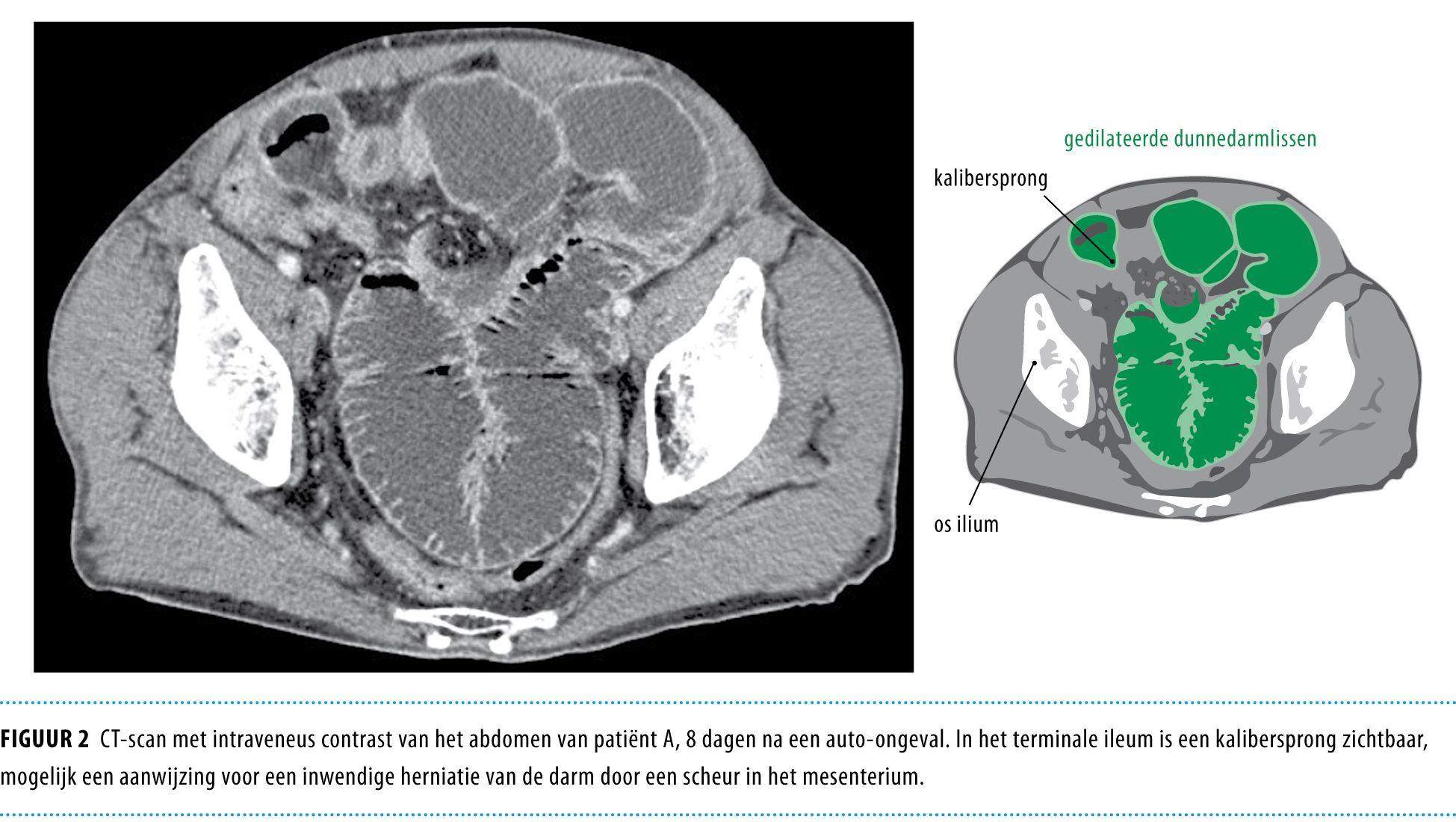 Een afdruk van de autogordel na een auto-ongeval | Nederlands ...