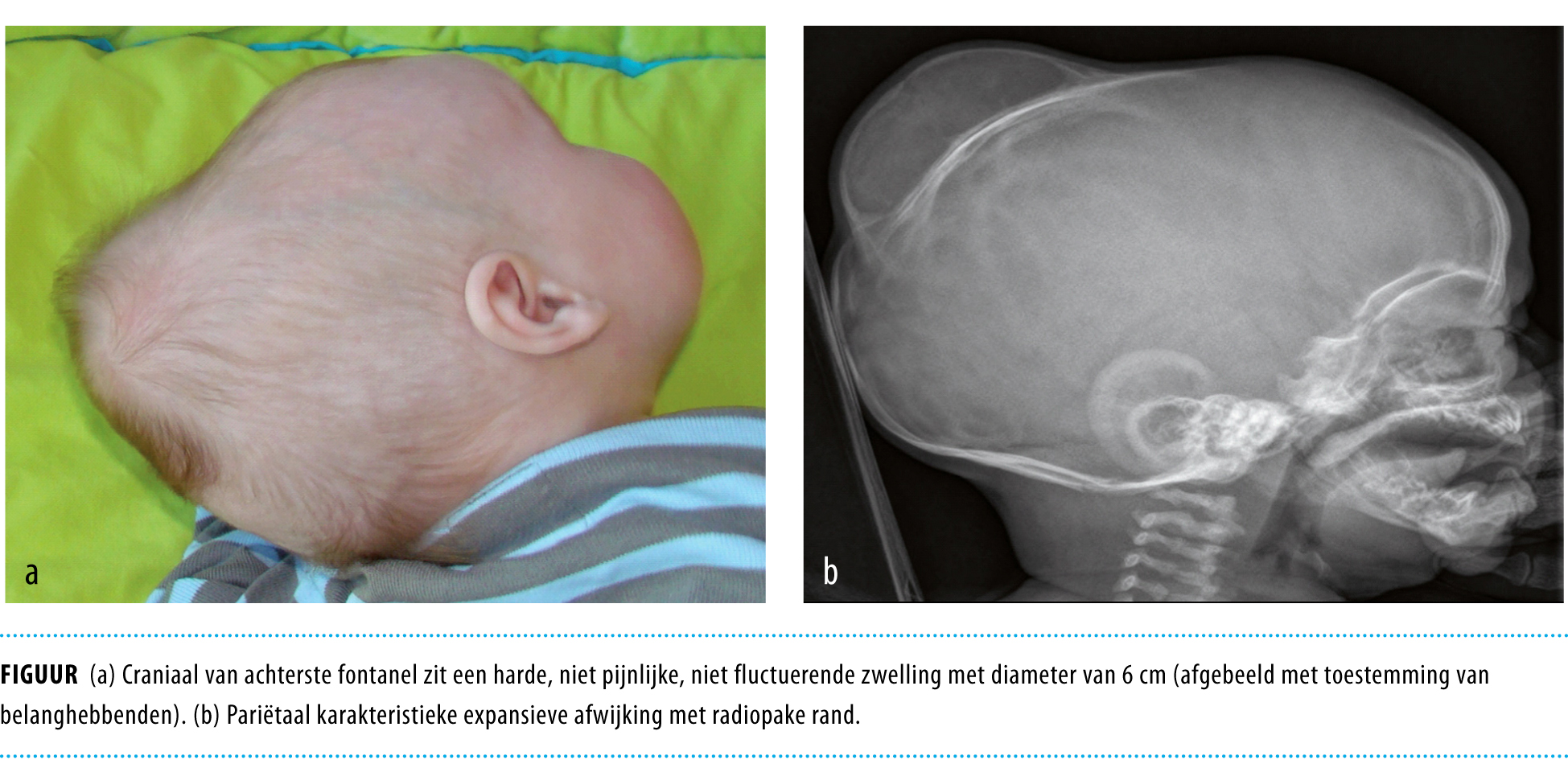 Een zuigeling met een zwelling op het hoofd | Nederlands Tijdschrift ...