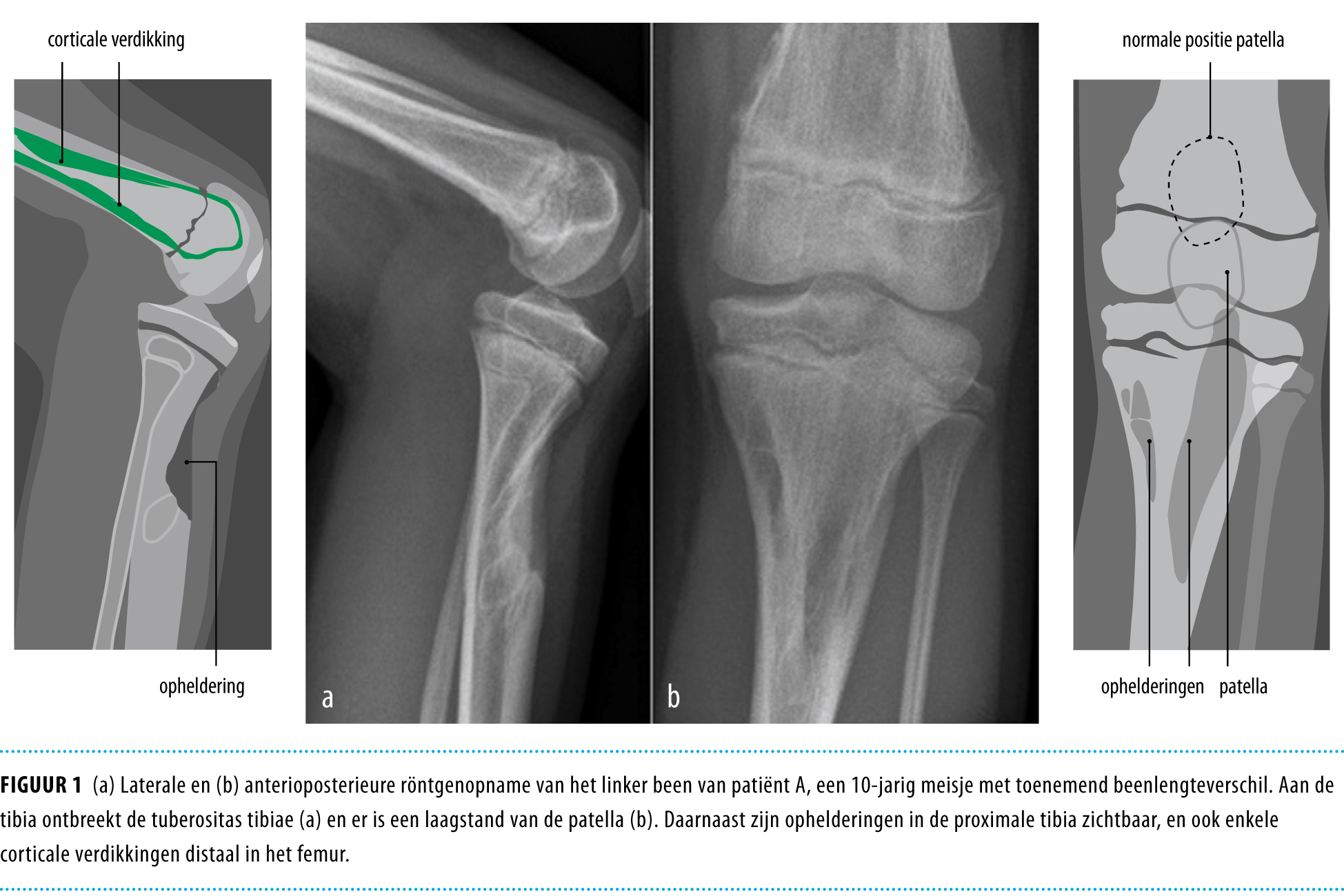 Proximale Tibia
