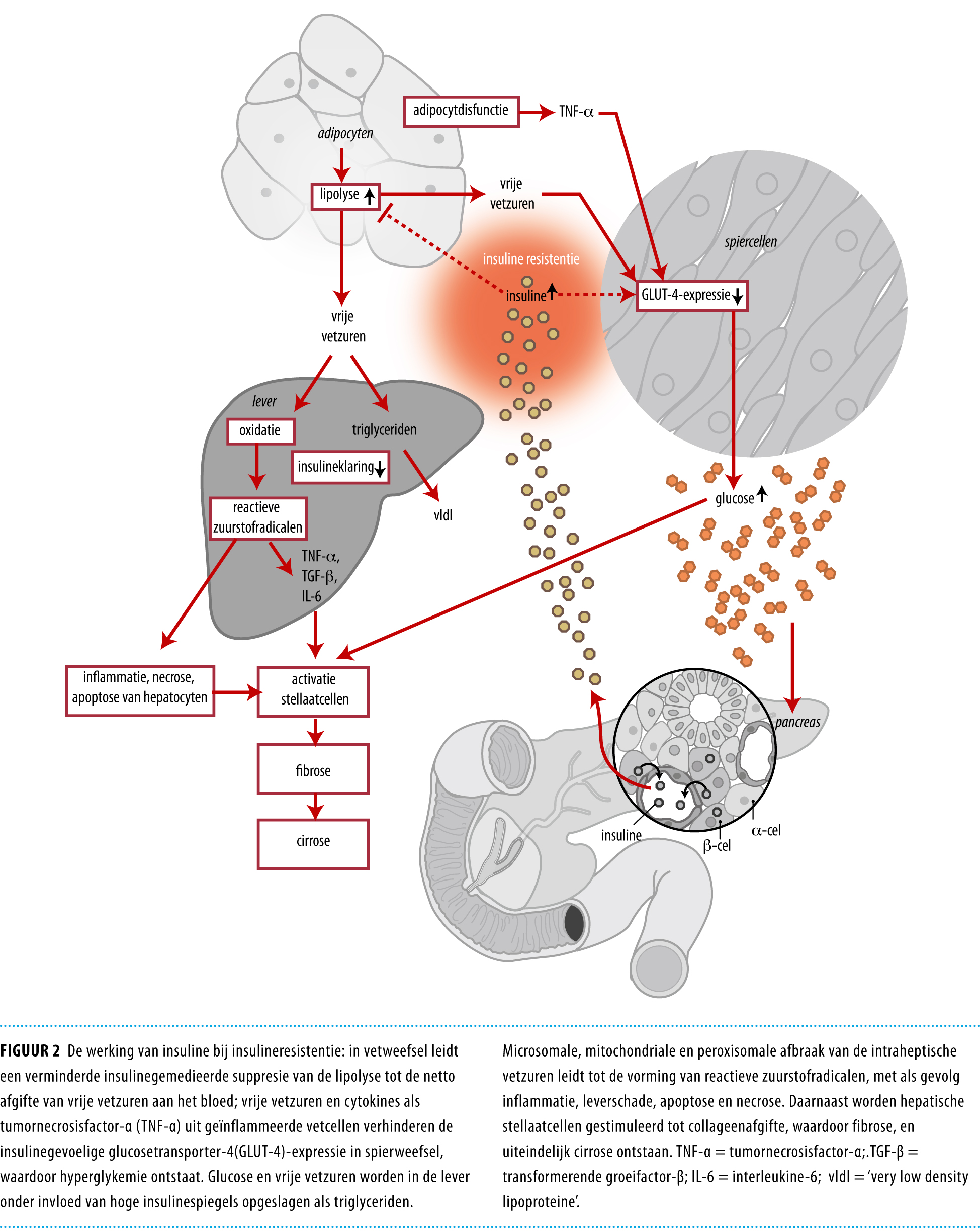 Diabetes mellitus en levercirrose: prognostisch ongunstige combinatie ...