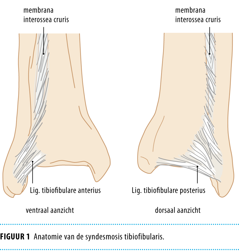 Ossificatie van de syndesmose na enkeltrauma | Nederlands Tijdschrift ...