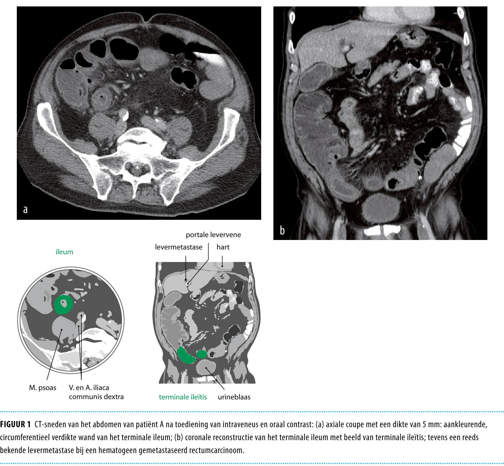 Ileitis Terminalis