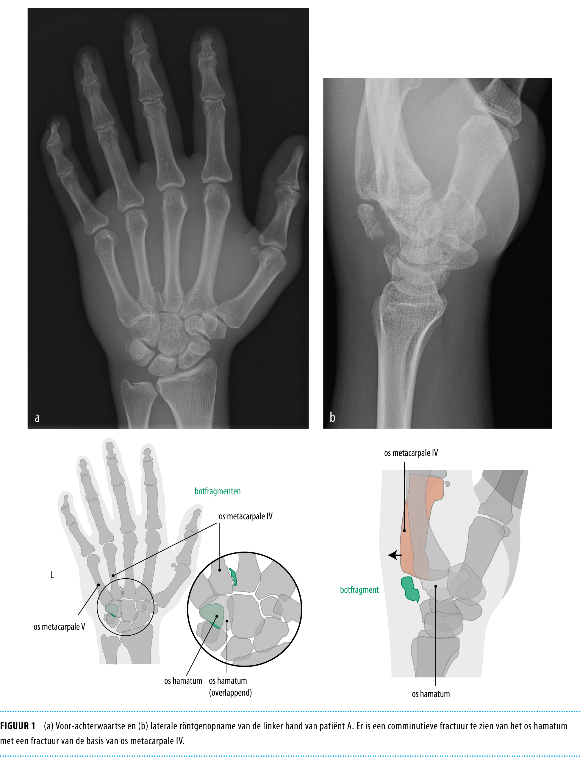 Fractuur van een os hamatum en een os metacarpale | Nederlands ...