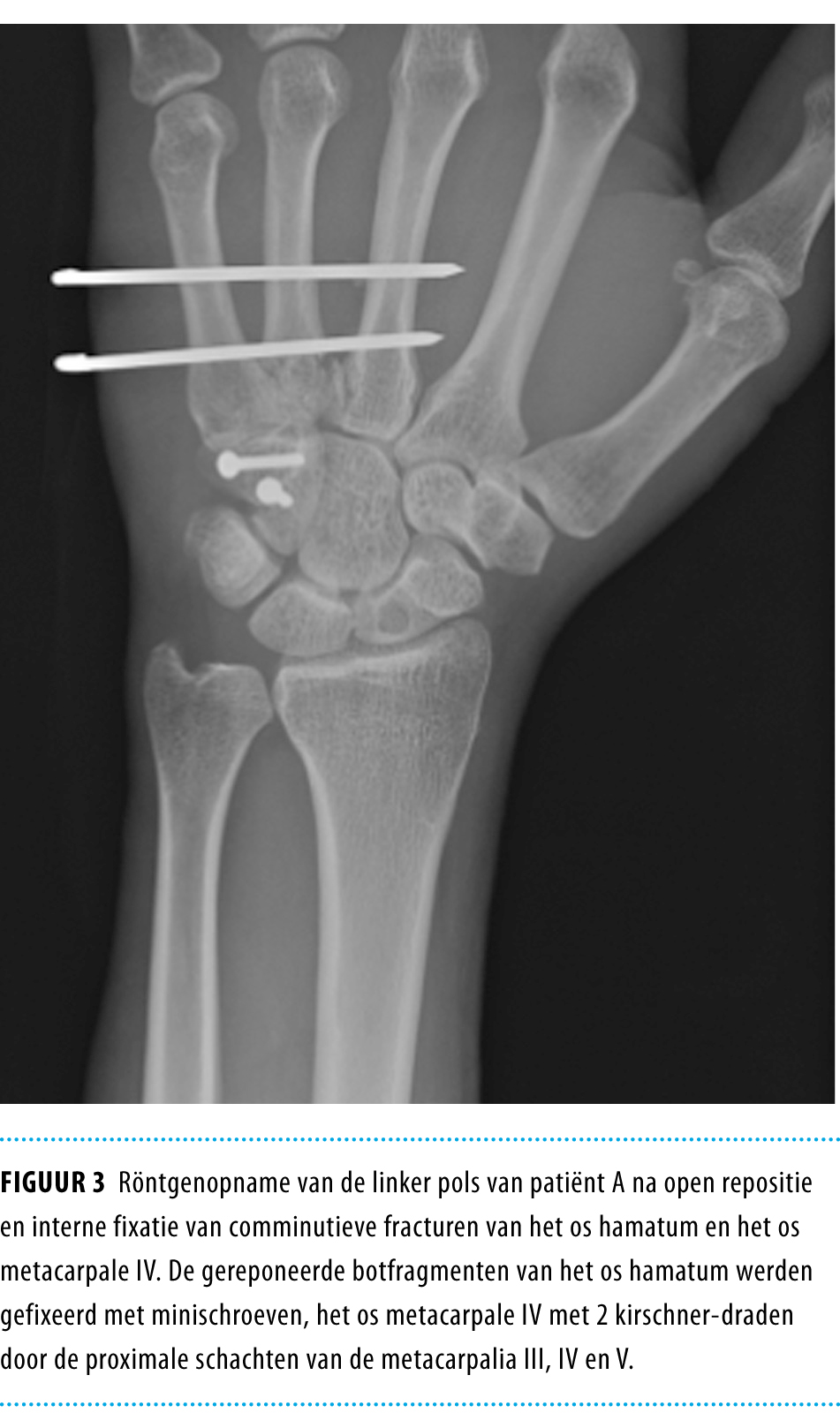 Fractuur van een os hamatum en een os metacarpale | Nederlands ...