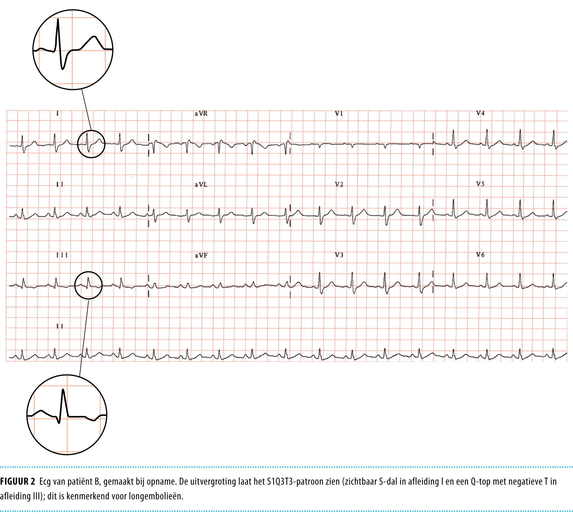 Longembolie Ecg / Pulmonary Pressures and ECG Patterns | EMS 12 Lead ...