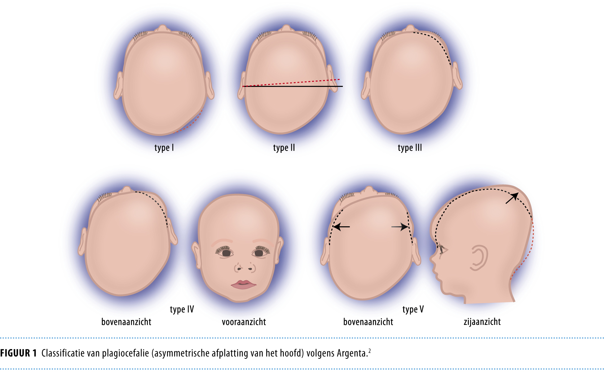 Zuigelingen met een scheef hoofd | Nederlands Tijdschrift voor Geneeskunde
