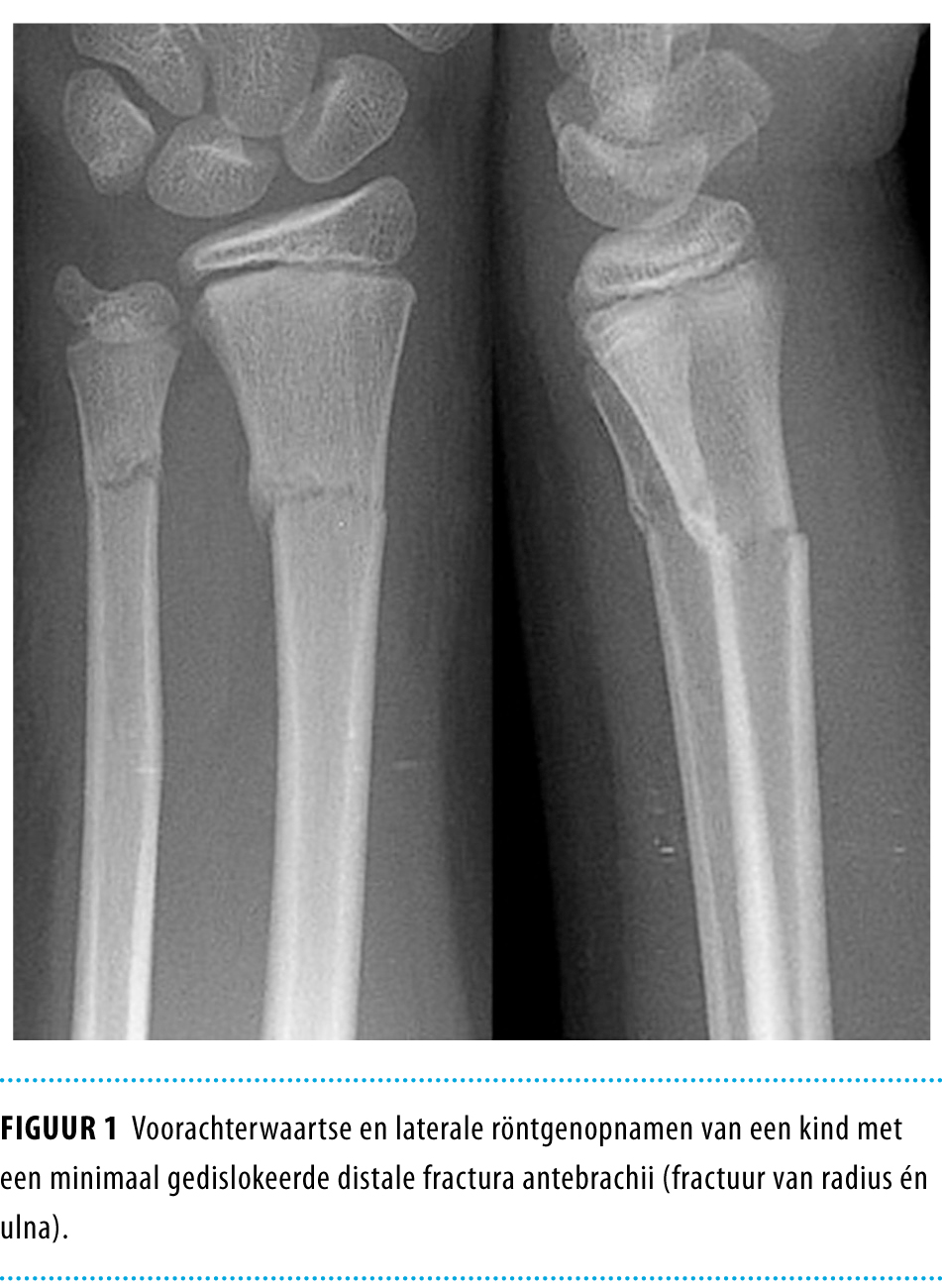Onderarmgips bij distale fracturen van radius én ulna* | Nederlands ...