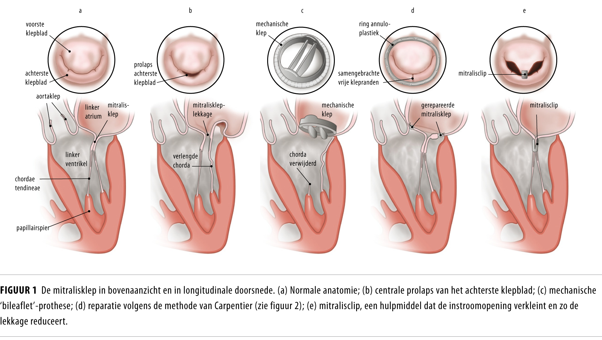 Mitralisklepinsufficiëntie: het lek te lijf | Nederlands Tijdschrift ...